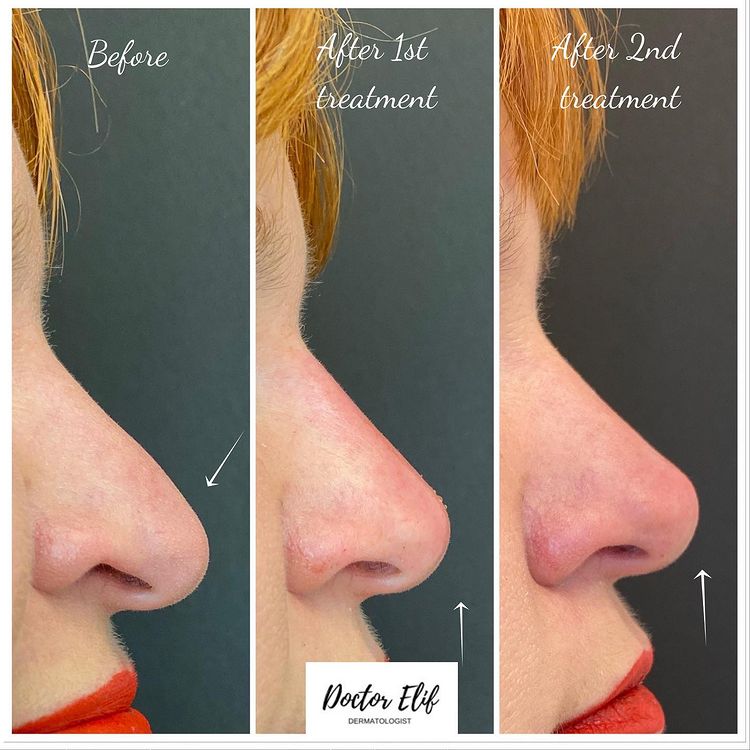 Nose Filler – Dr. Elif Clinic Non Surgical Rhinoplasty – liquid Rhinoplasty