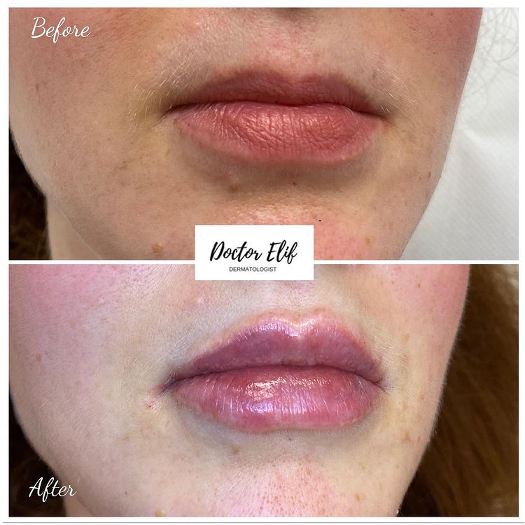 Lip Filler – Dr. Elif Clinic