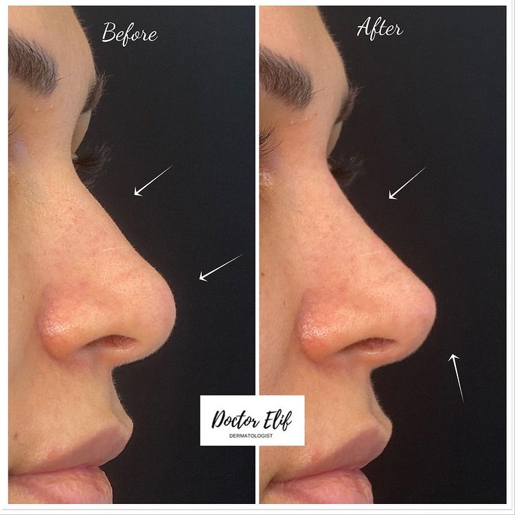 Nose Filler – Dr. Elif Clinic Non Surgical Rhinoplasty – liquid Rhinoplasty