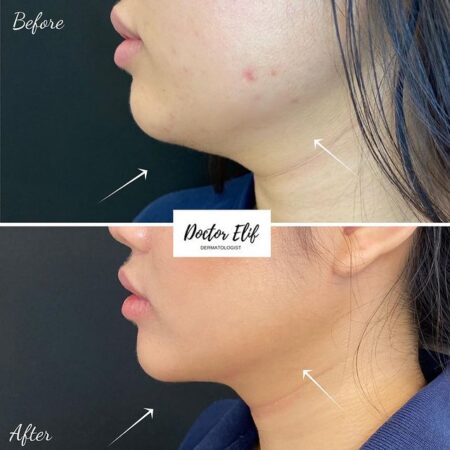 Fat Dissolving Injections – Dr. Elif Clinic – Double chin Removal