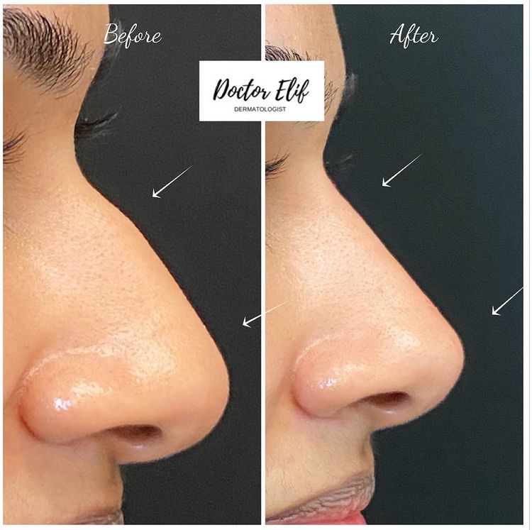 Nose Filler – Dr. Elif Clinic Non Surgical Rhinoplasty – liquid Rhinoplasty