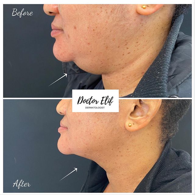 Fat Dissolving Injections at Dr. Elif Clinic in London