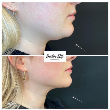 Fat Dissolving Injections – Dr. Elif Clinic – Double chin Removal