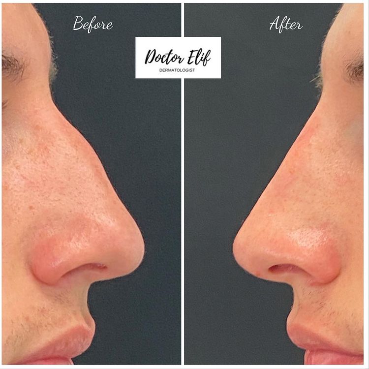 Nose Filler – Dr. Elif Clinic Non Surgical Rhinoplasty – liquid Rhinoplasty