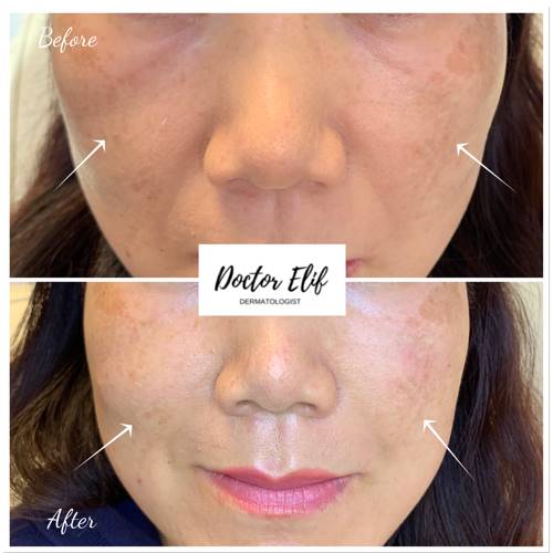 Cheek Fillers – Dr. Elif Clinic