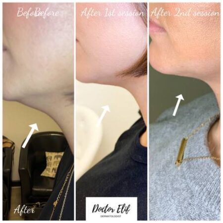 Fat Dissolving Injections – Dr. Elif Clinic – Double chin Removal