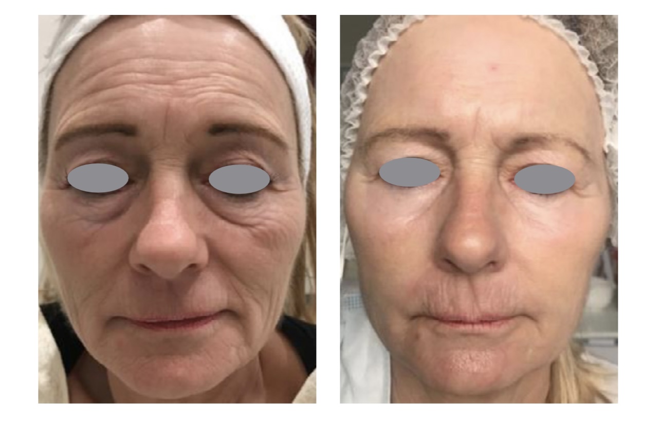 Tixel Treatment – skin resurfacing, fine wrinkles, skin tightening ...