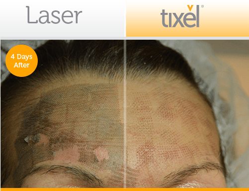 Tixel Treatment – skin resurfacing, fine wrinkles, skin tightening ...