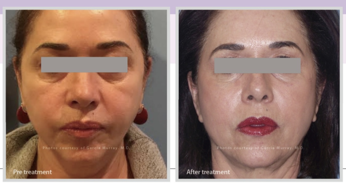 HIFU - High Intensity Focused Ultrasound | Dr. Elif Clinic