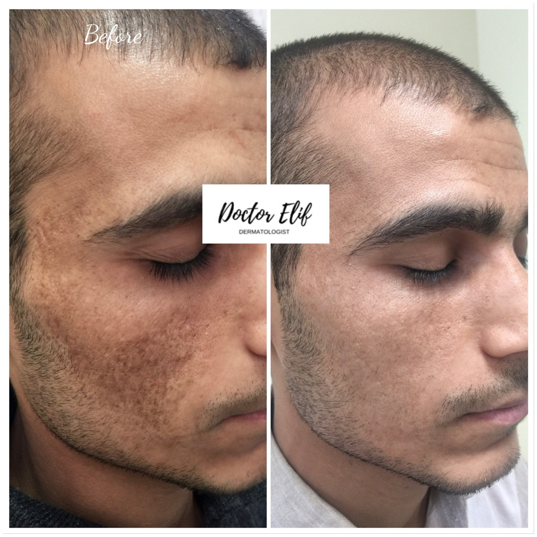 Hyperpigmentation/ Melasma | Dr. Elif Clinic